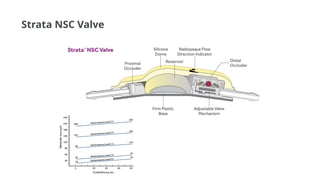 tipe tipe shunt yang biasanya digunakan untuk operasi BS | PPTX