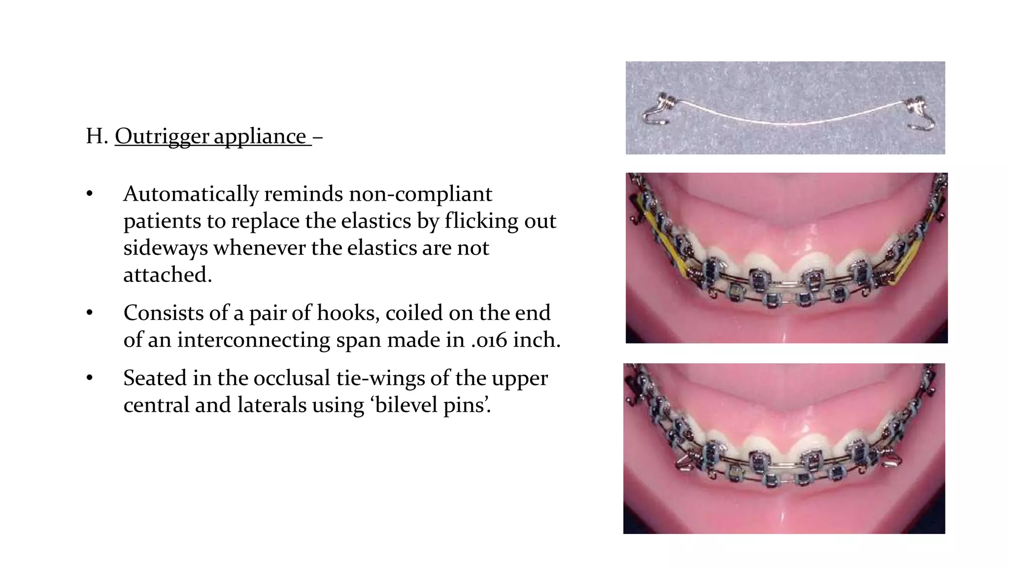 Tip edge mechanics | PPTX