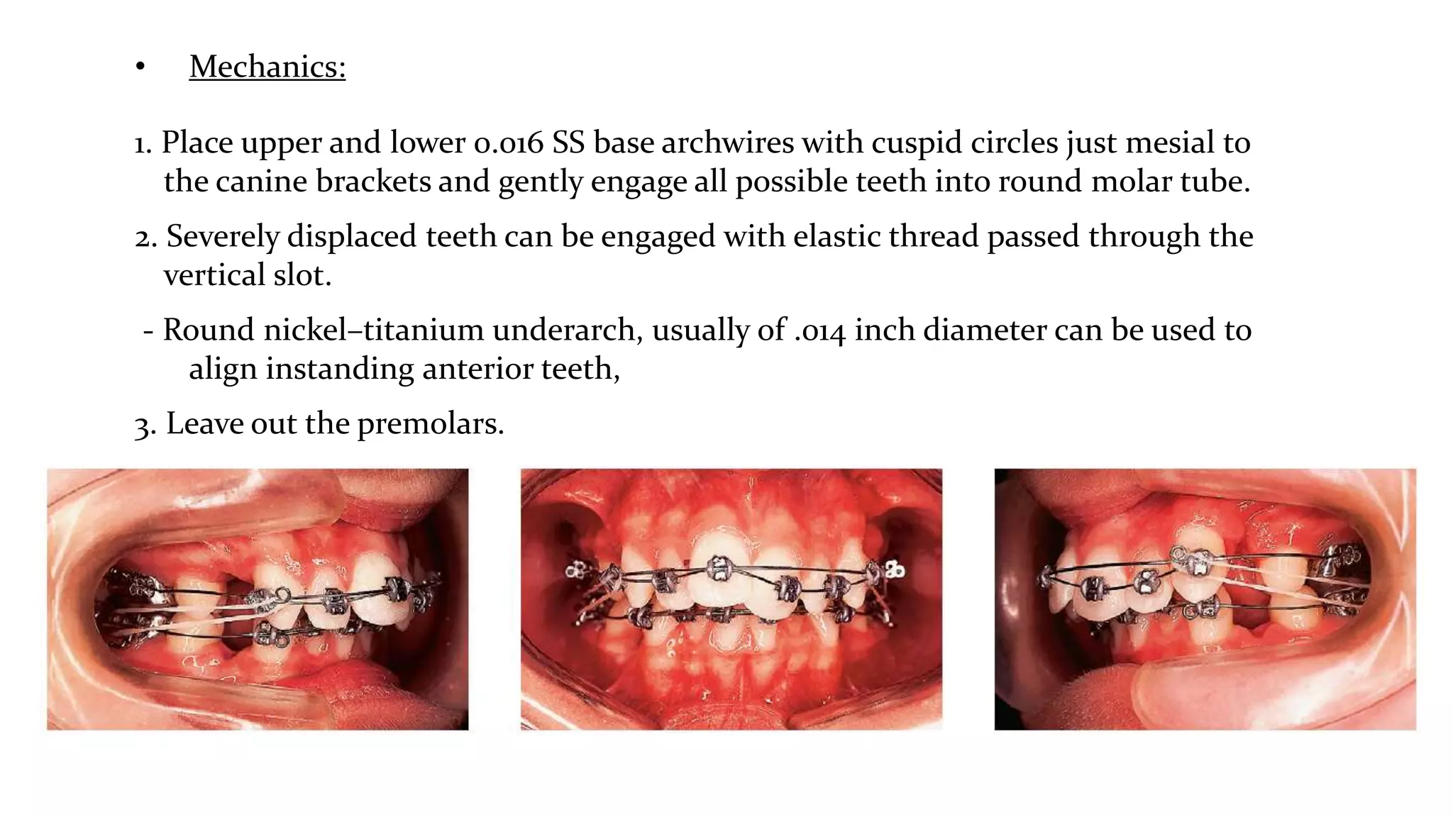 Tip edge mechanics | PPTX