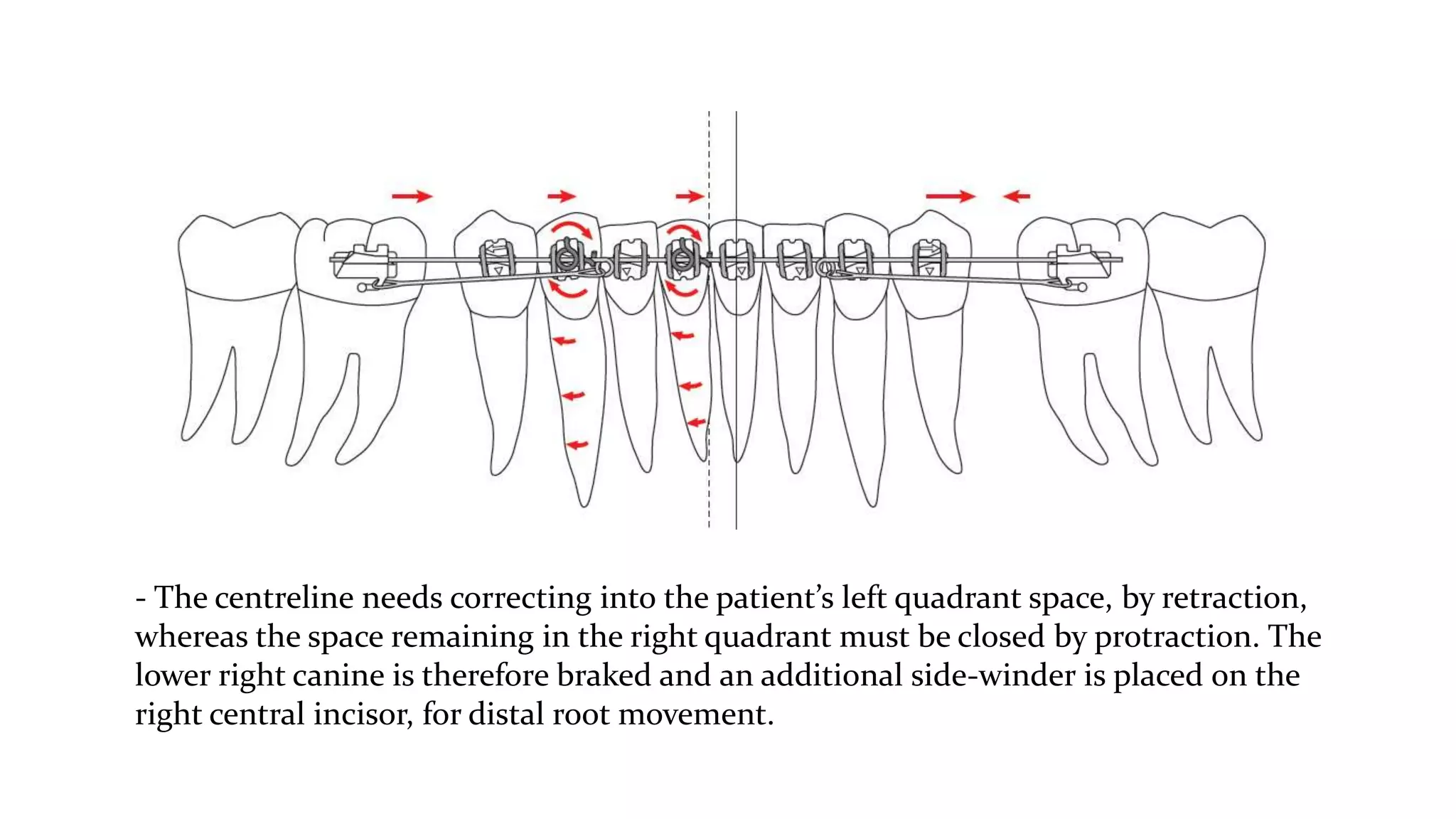 Tip edge mechanics | PPTX