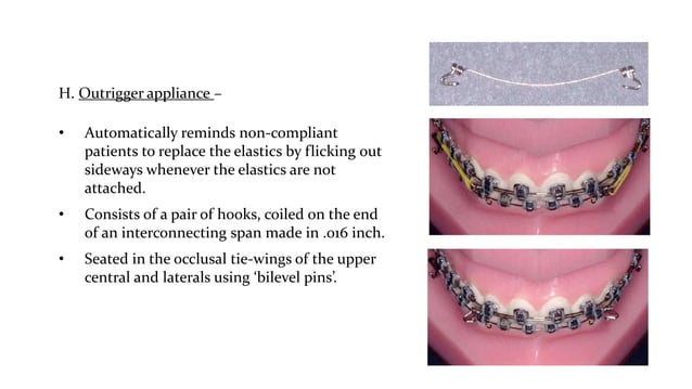 Tip edge mechanics | PPTX
