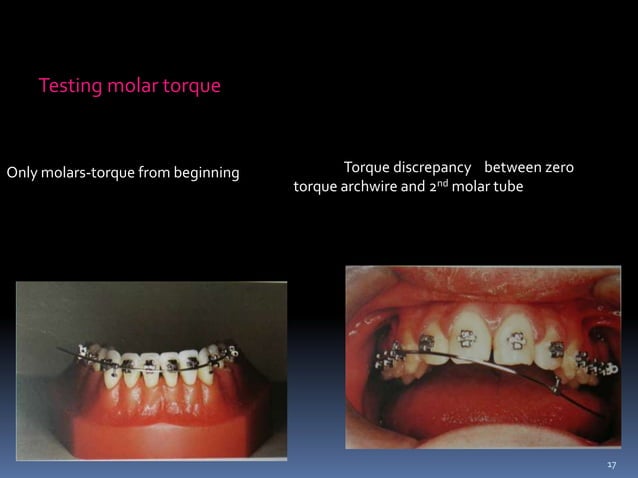 Tip edge orthodontics stage III | PDF