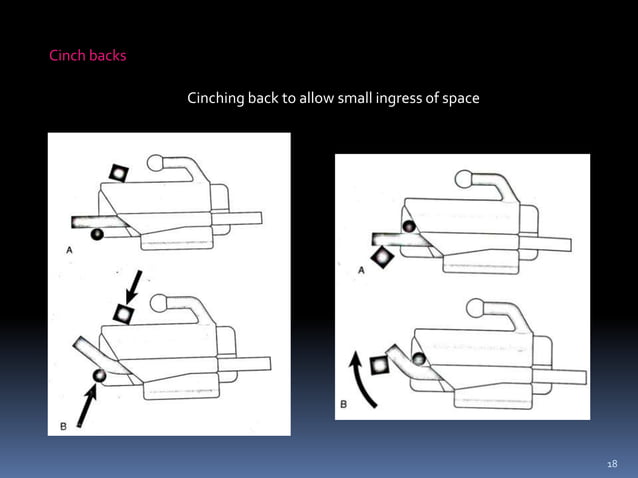 Tip edge orthodontics stage III | PDF