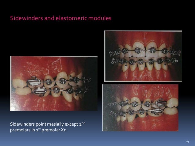 Tip edge orthodontics stage III