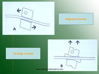 Tip edge technique | PPT