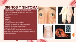 TIPOS DE ANEMIA N.pptx