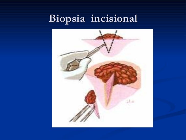 Tipos de biopsias