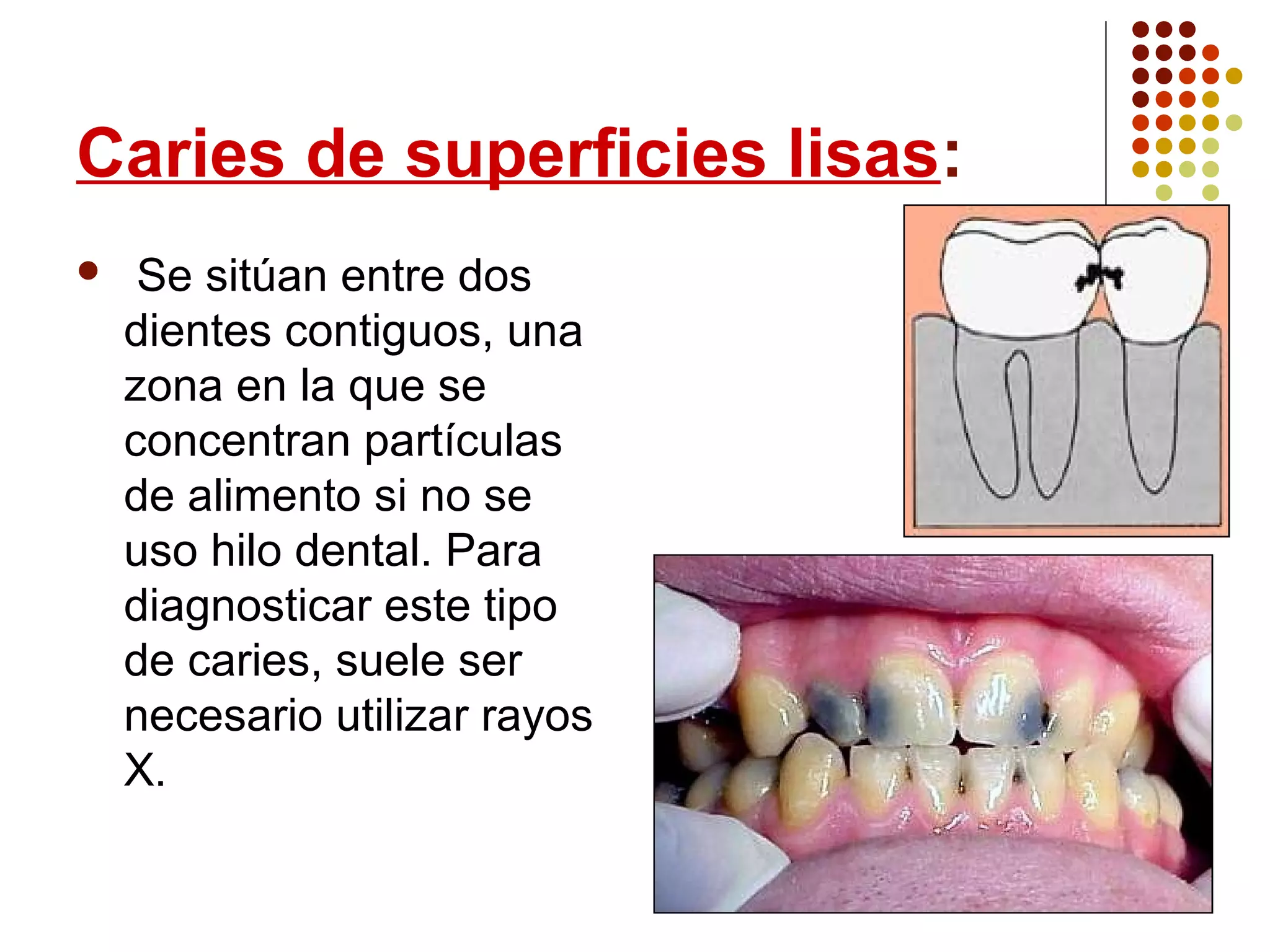 Tipos de caries | PPT