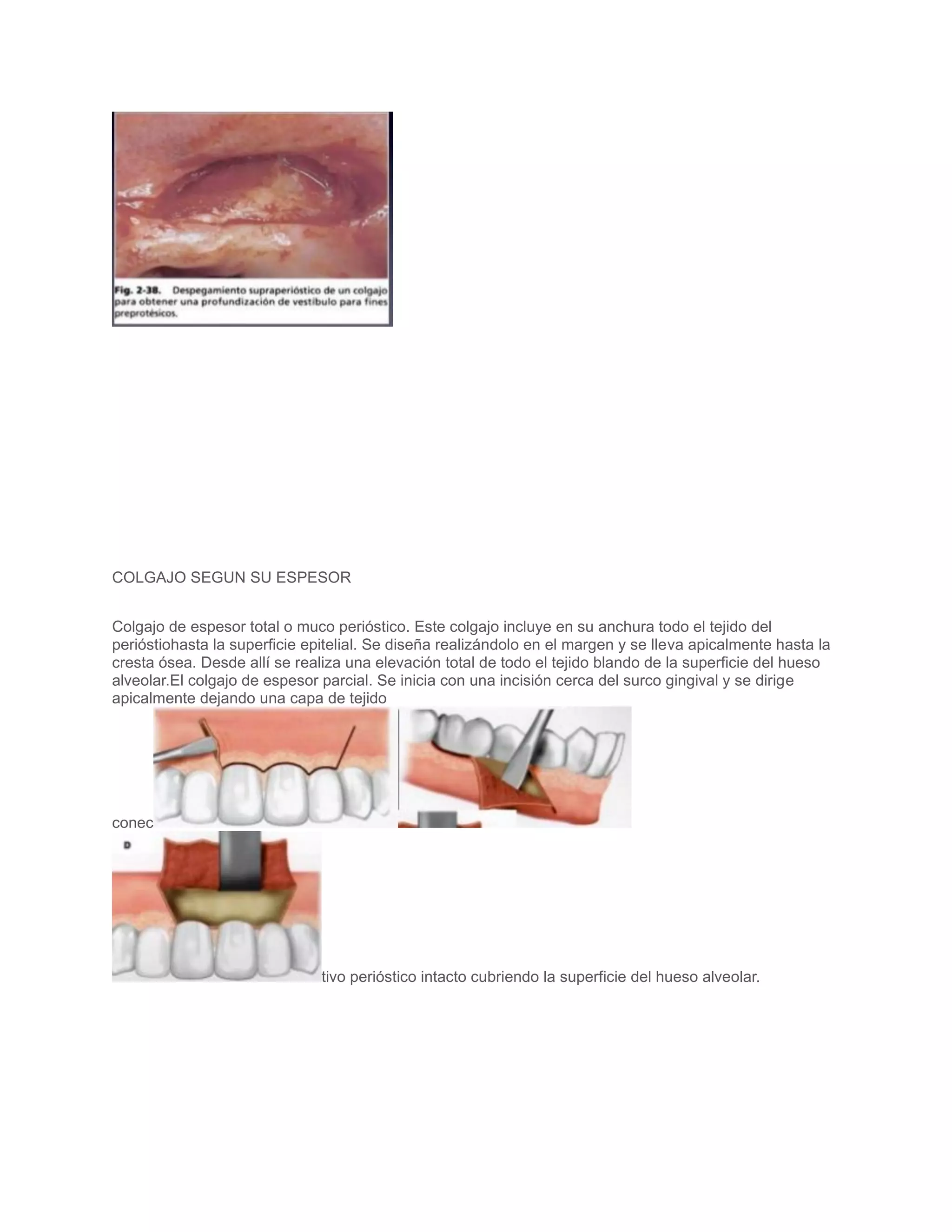 Tipos de colgajos en Odontologia- Dr Ricardo Cardozo.pdf