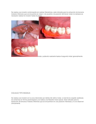 Tipos de colgajos en Odontologia- Dr Ricardo Cardozo.pdf