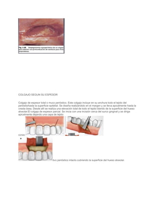 Tipos de colgajos en Odontologia- Dr Ricardo Cardozo.pdf