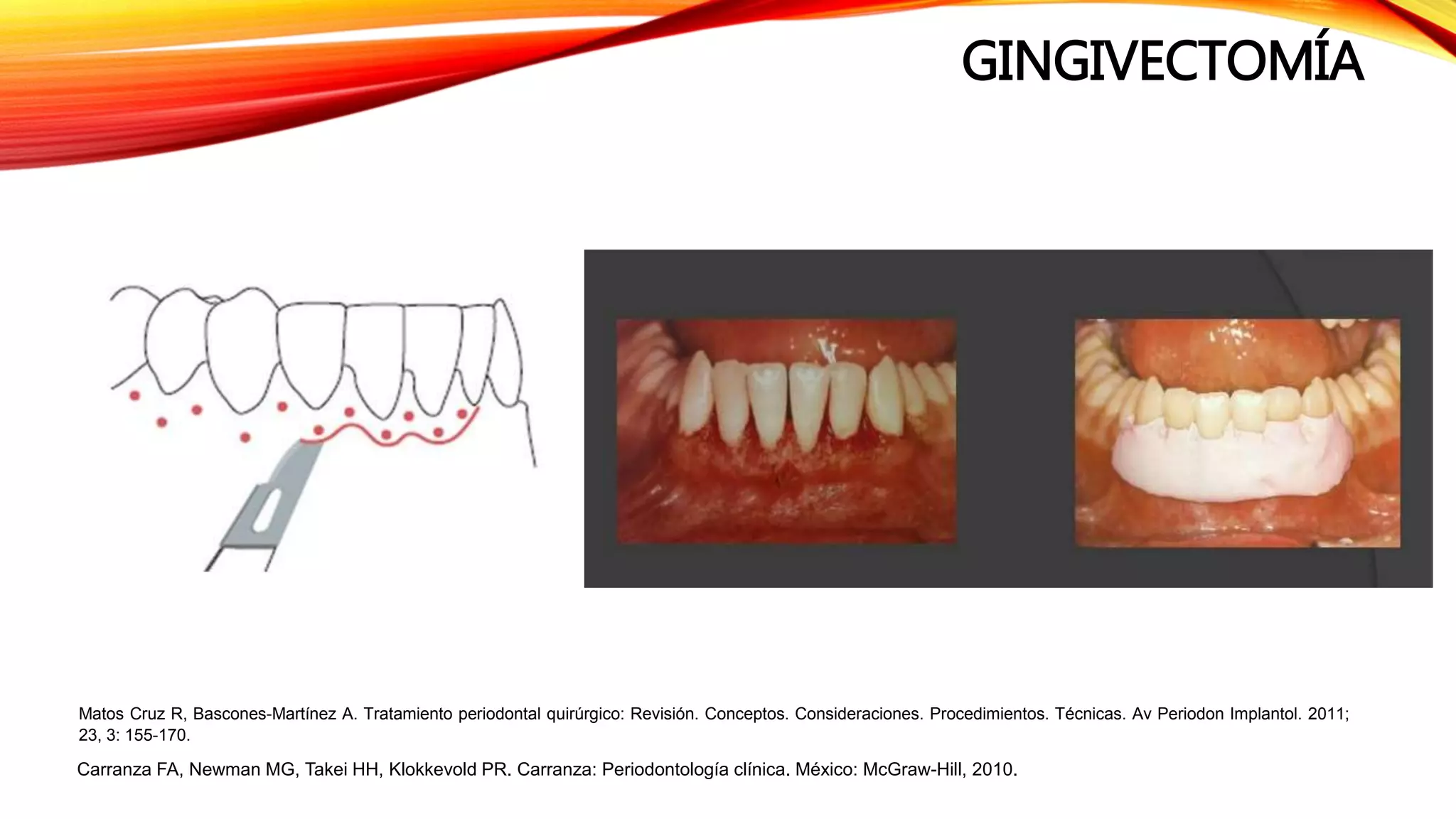 Tipos de defectos óseos, Cirugia resectiva de los tejidos blandos | PPTX