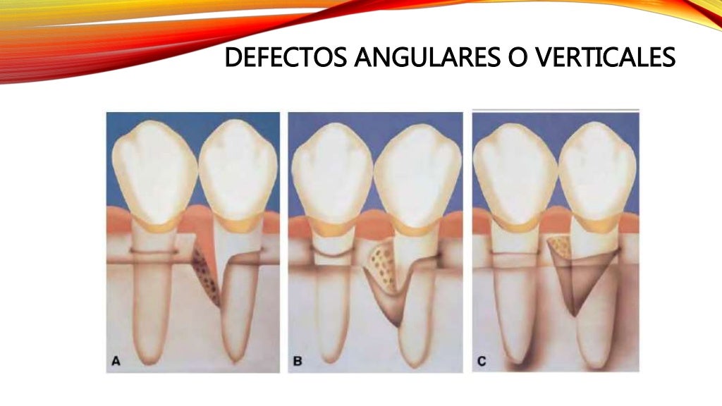 Tipos de defectos óseos, Cirugia resectiva de los tejidos blandos