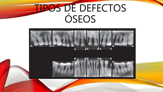 Tipos de defectos óseos, Cirugia resectiva de los tejidos blandos