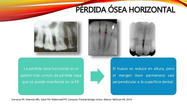 Tipos de defectos óseos, Cirugia resectiva de los tejidos blandos