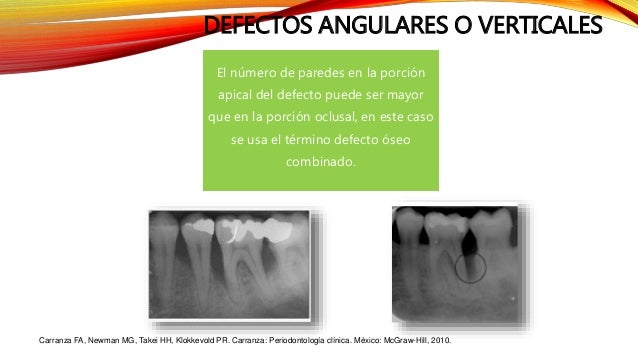 Tipos de defectos óseos, Cirugia resectiva de los tejidos blandos