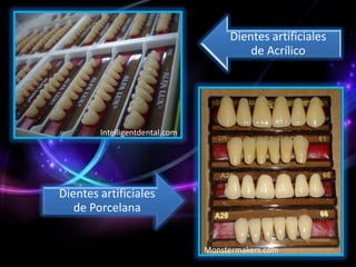 Tipos de dientes artificiales | PPTX