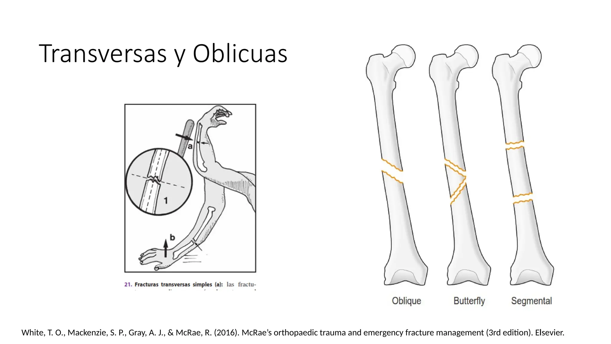 Tipos de fractura-generalidades-ult.pptx
