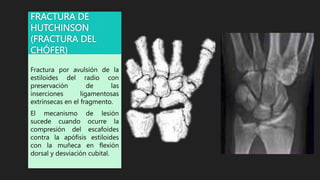 TIPOS DE FRACTURAS DISTALES DEL RADIO.pptx