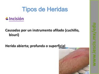 TIPOS DE HERIDAS | PPTX