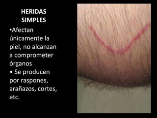 Tipos de heridas | PPTX