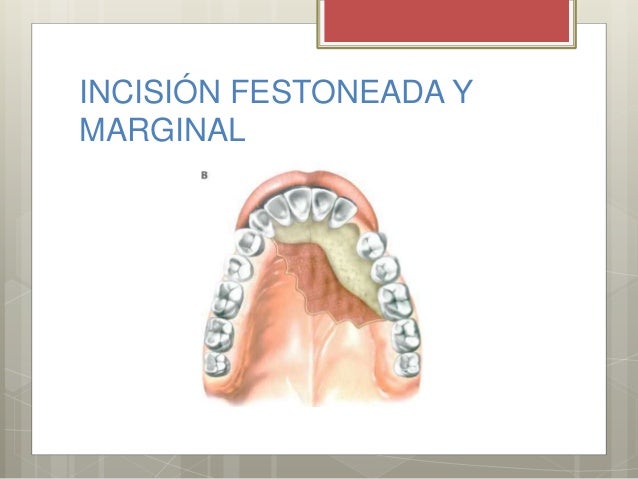 Tipos de incisión y colgajos