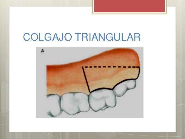 Tipos de incisión y colgajos