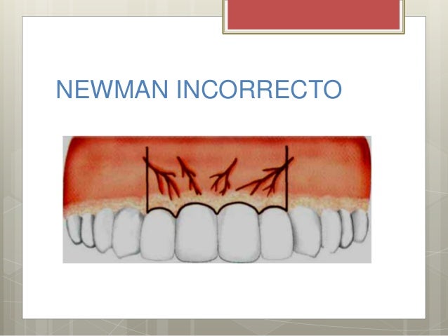 Tipos de incisión y colgajos