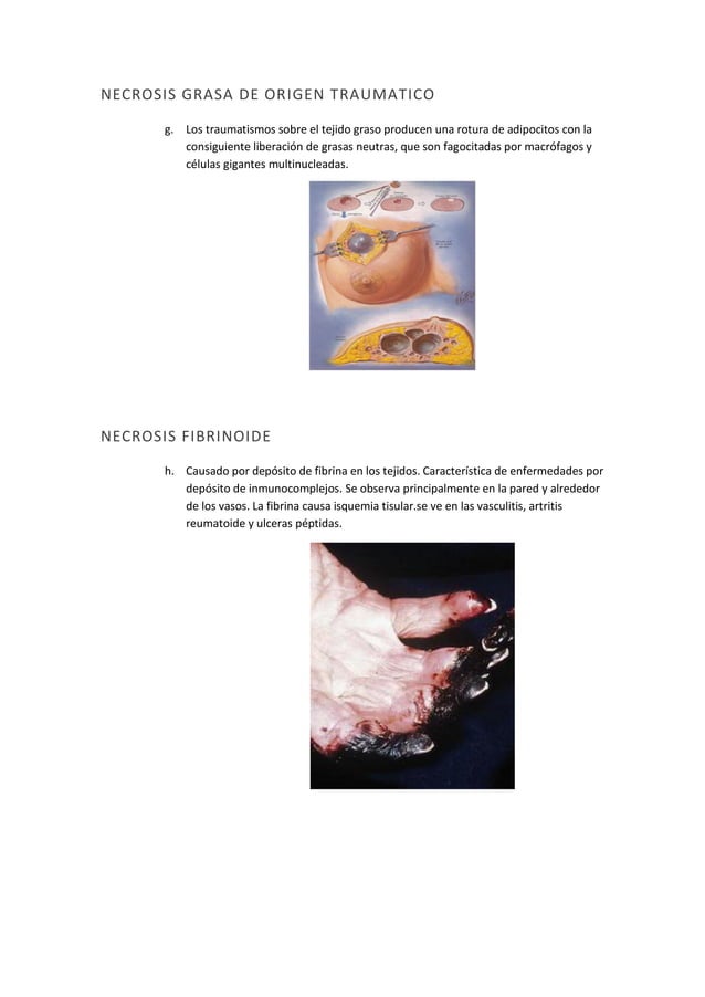 Tipos de Necrosis | PDF | Medical Health