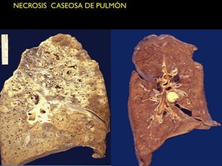 Tipos de Necrosis y cómo tratarla correctamente | PDF