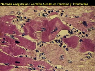 Tipos de Necrosis y cómo tratarla correctamente | PDF