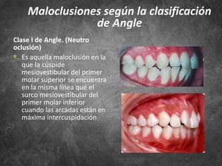 Tipos de oclusión | PPTX