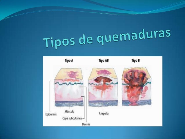 ¿Cuáles Son Las Quemaduras De Primer Grado – CFZHF
