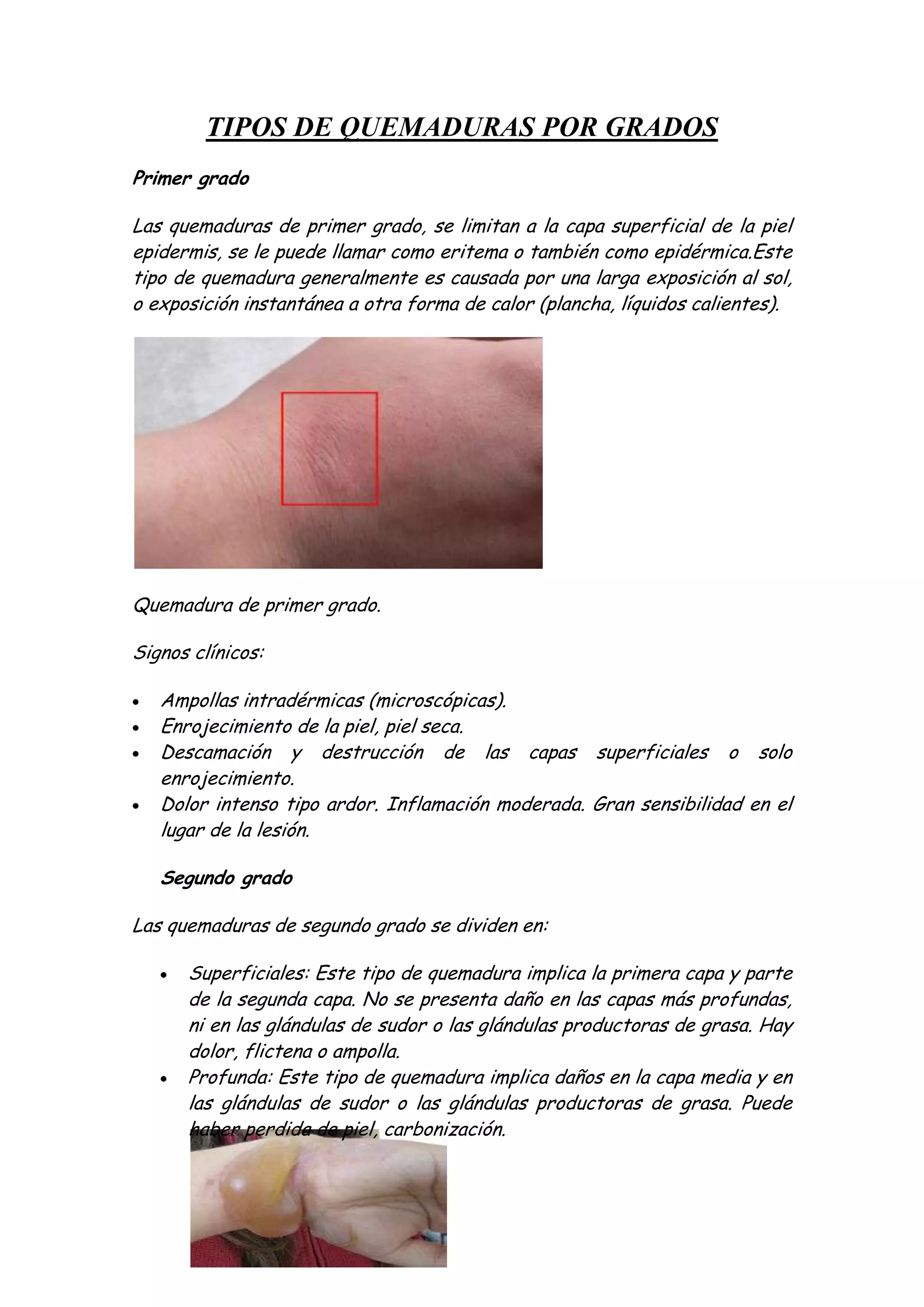 Tipos de quemaduras por grados | DOCX | Skin and Dermatology | Diseases ...