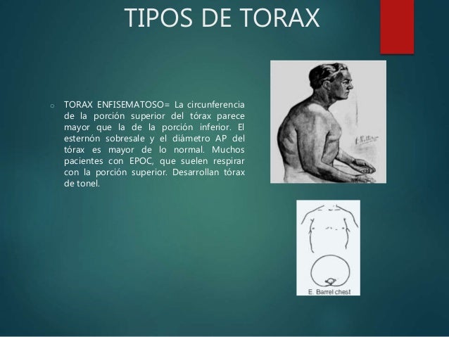 Tipos de torax