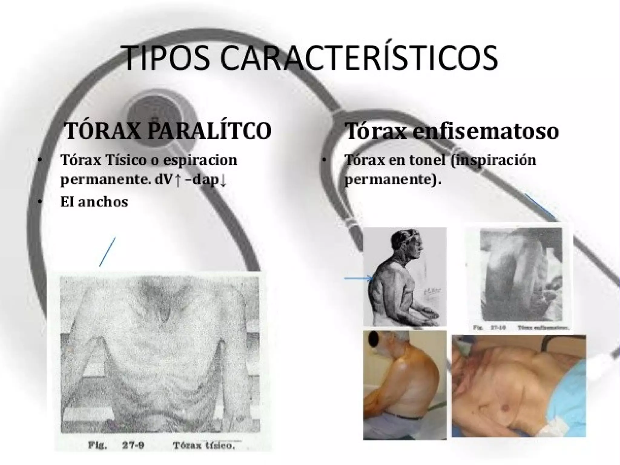 Tipos de tórax | PPT