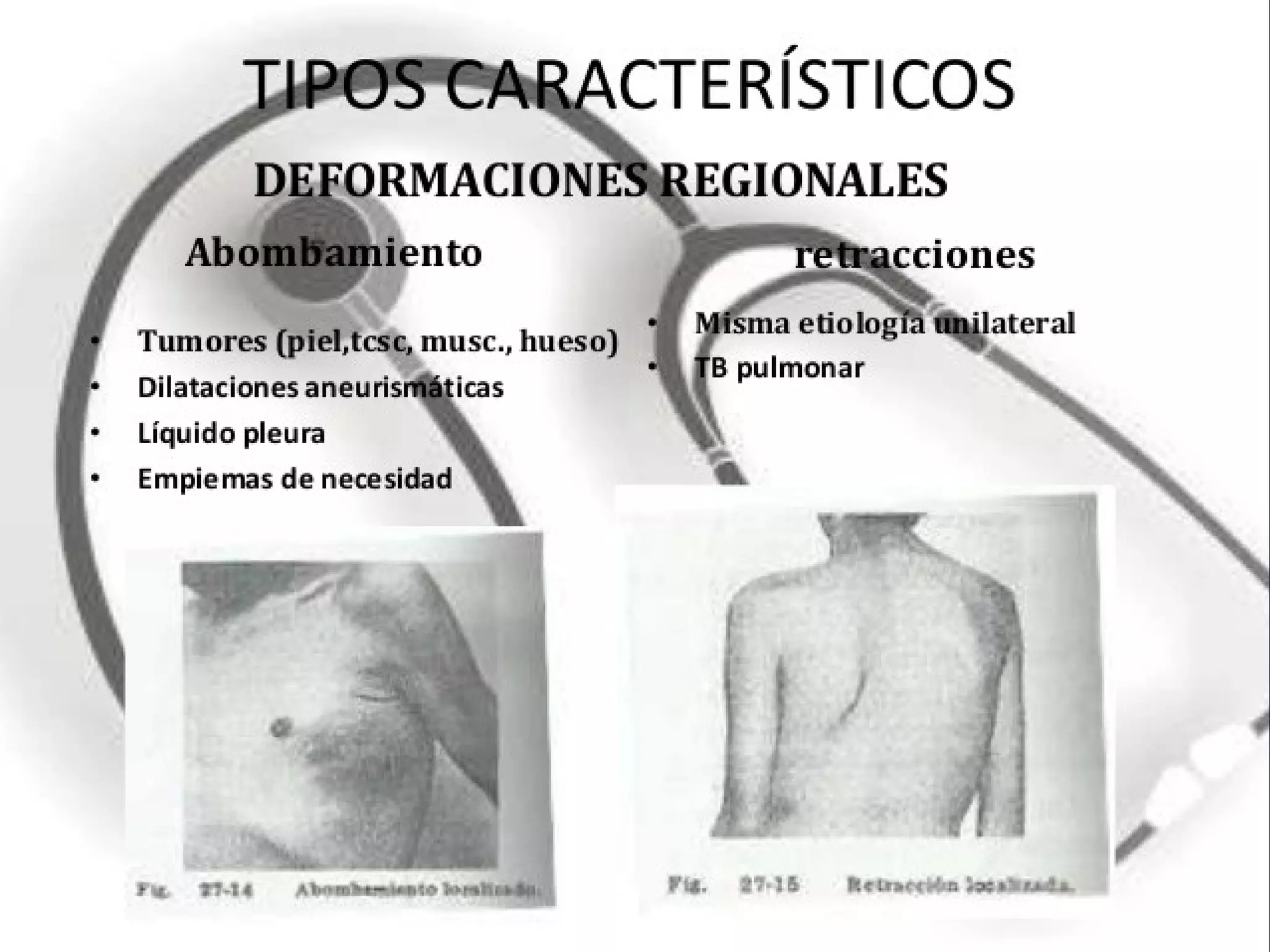 Tipos de tórax | PPT