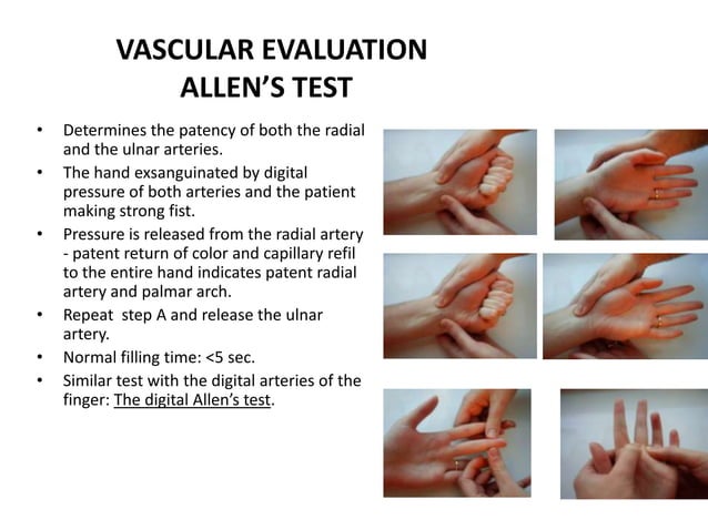 Tips on upper limb assessment | PPTX