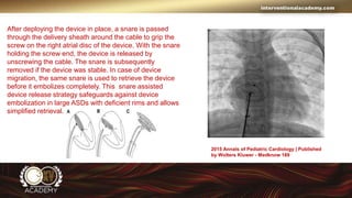 Tips and Tricks for ASD Closure in Adult.pptx