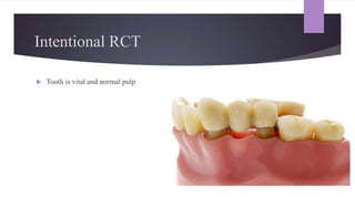 tips and tricks in root canal new 1.pptx