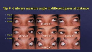 tips and tricks in squint evaluation.pptx