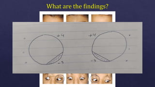tips and tricks in squint evaluation.pptx