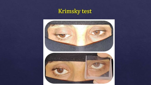 tips and tricks in squint evaluation.pptx