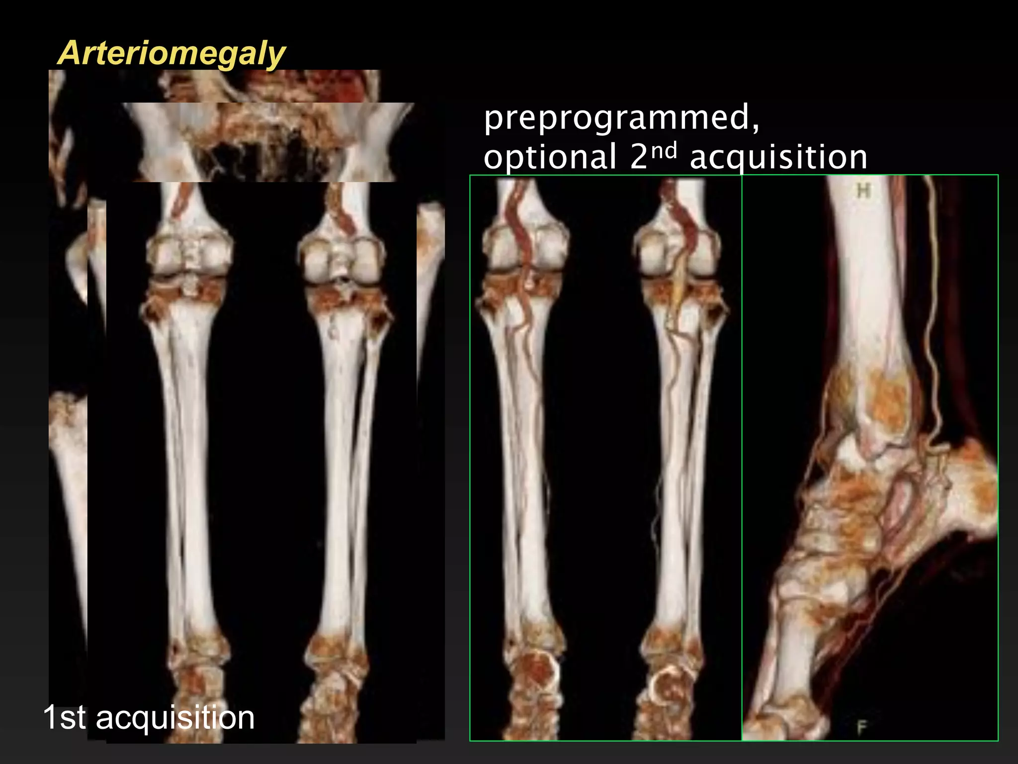 Tips and Tricks in Vascular Imaging (Lower Extremity CTA) | PDF