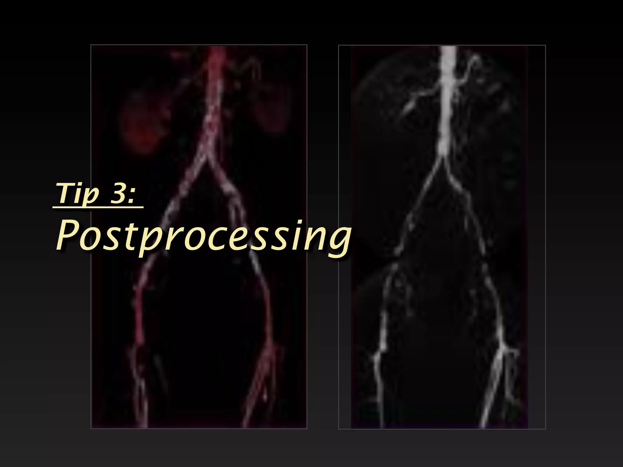 Tips and Tricks in Vascular Imaging (Lower Extremity CTA) | PDF