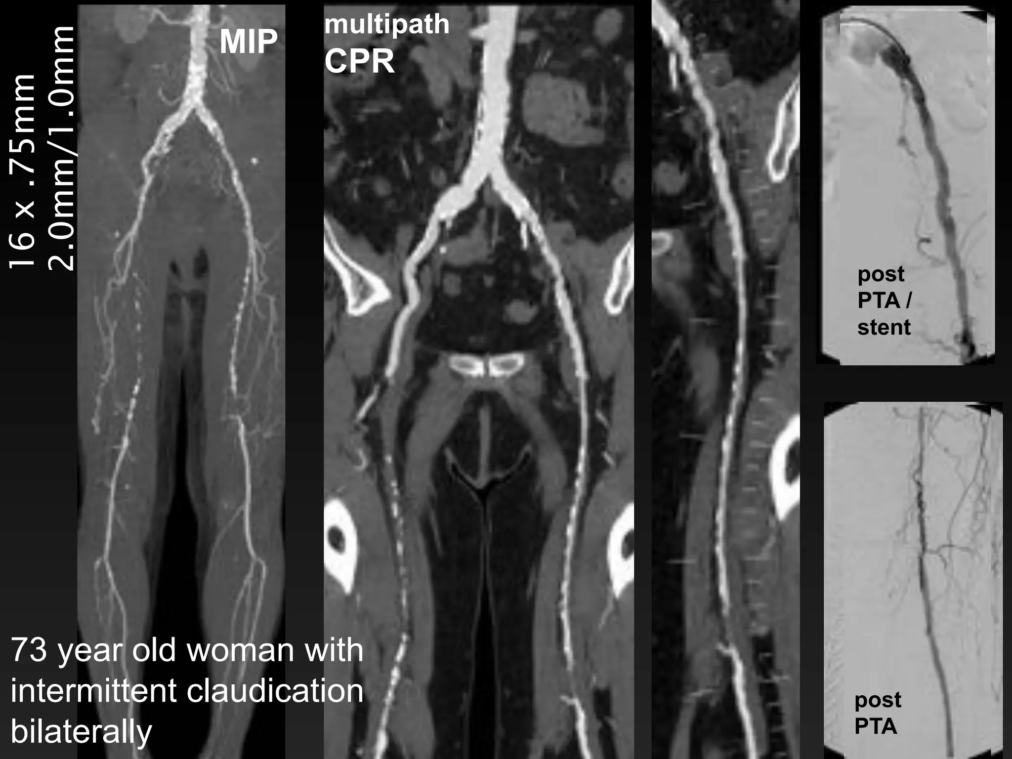 Tips and Tricks in Vascular Imaging (Lower Extremity CTA) | PDF