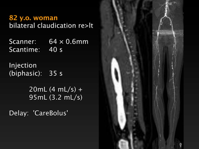 Tips and Tricks in Vascular Imaging (Lower Extremity CTA) | PPT