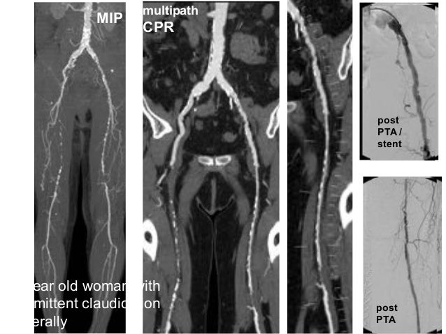 Tips and Tricks in Vascular Imaging (Lower Extremity CTA)