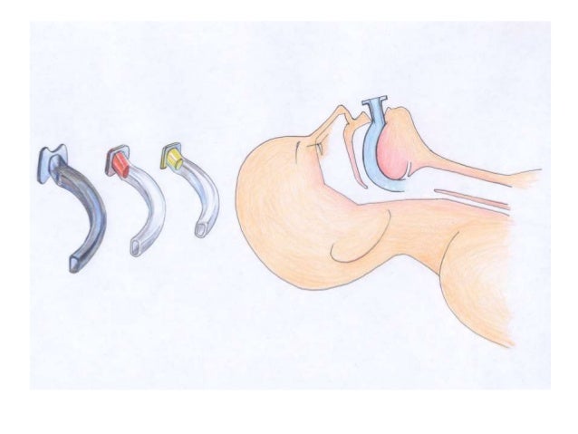 Tips in otolaryngology anesthesia | PPT