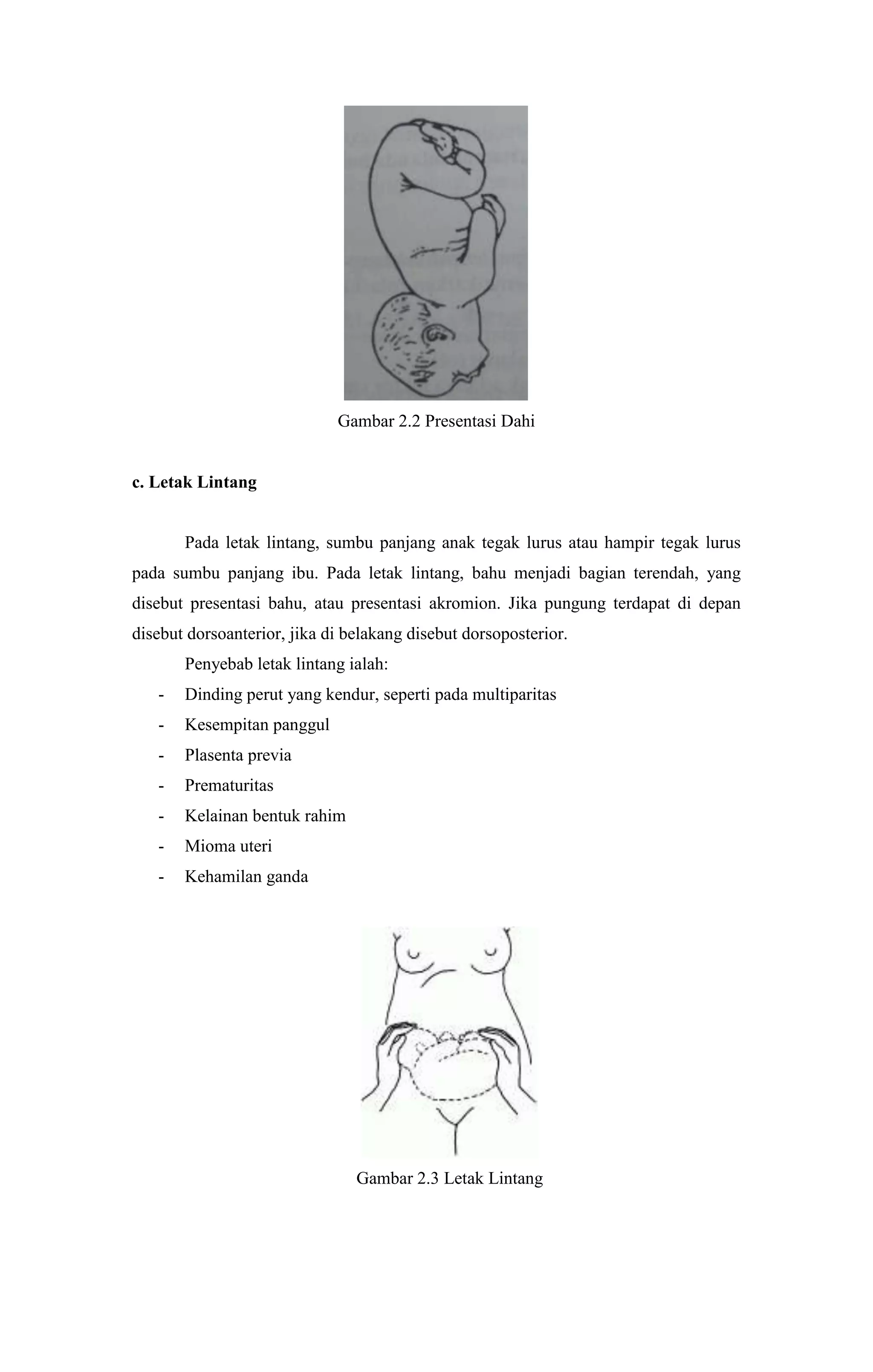 DISPROPORSI KEPALA PANGGUL | DOCX